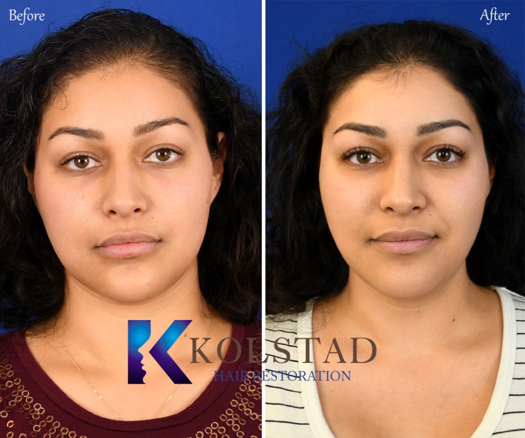 Platelet Rich Plasma Hair Treatment | Kolstad Hair Restoration