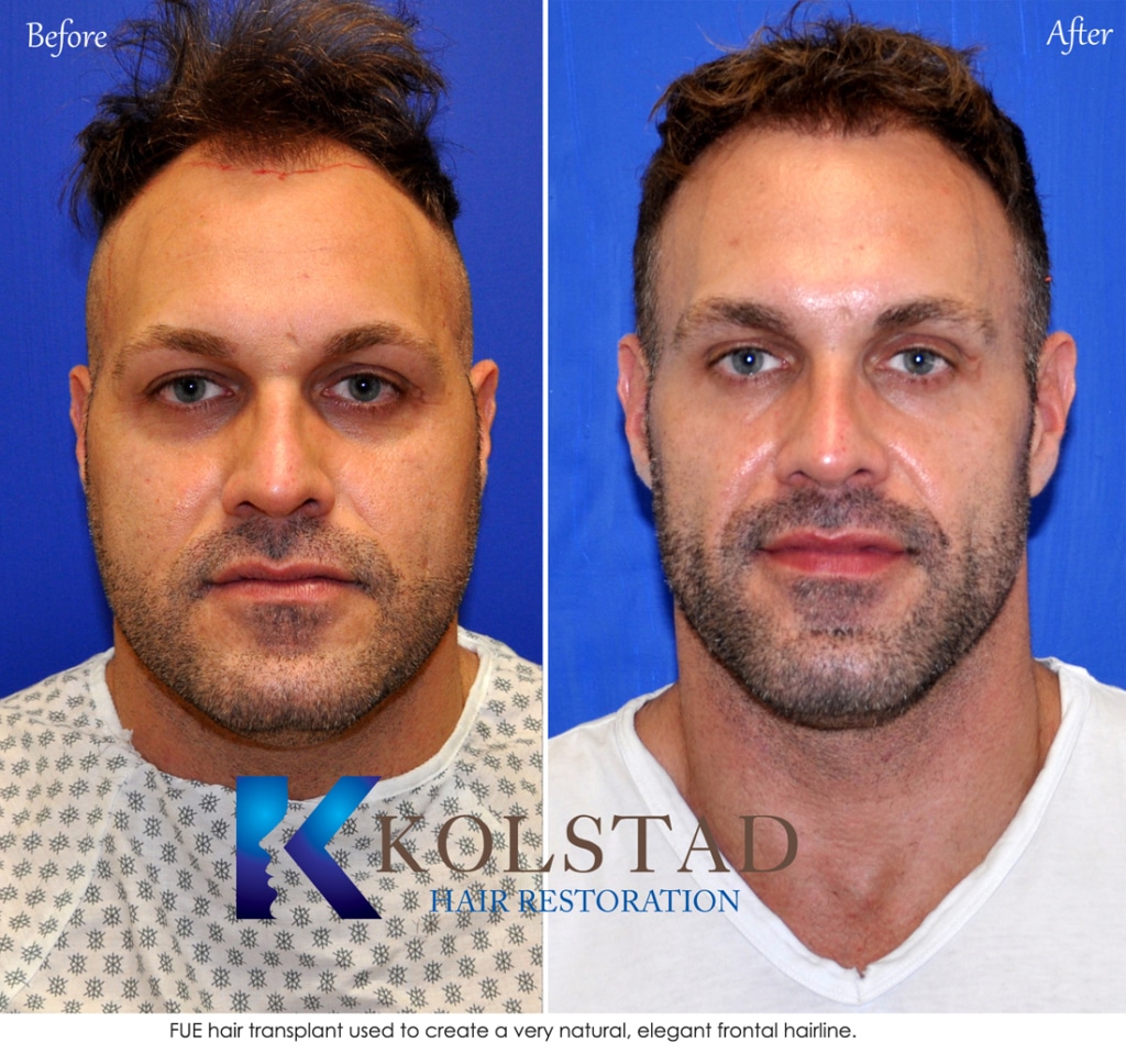 La Jolla Hair Clinic Kolstad Hair Restoration