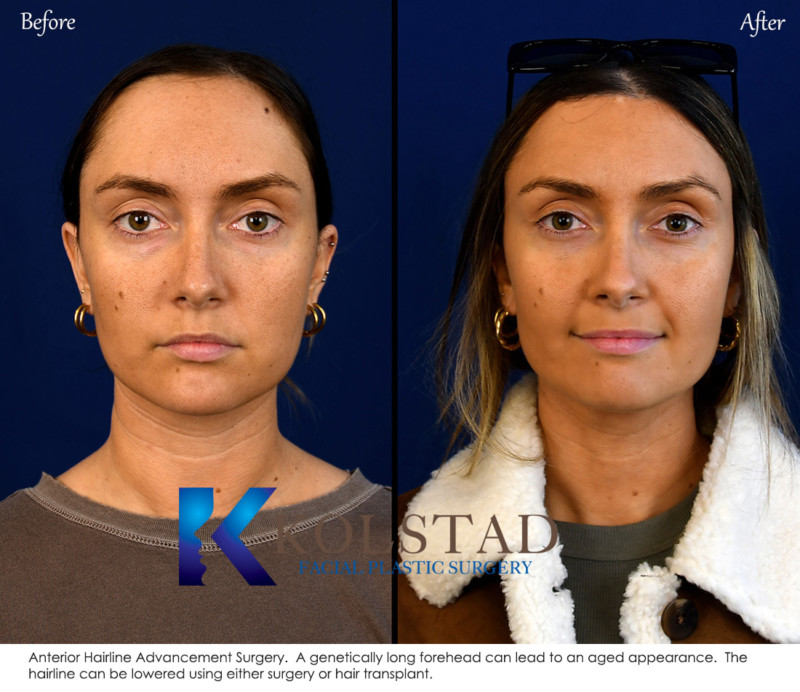 Hairline Advancement Surgery | Kolstad Hair Restoration