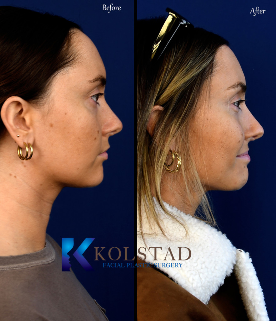 Hairline Advancement Surgery | Kolstad Hair Restoration