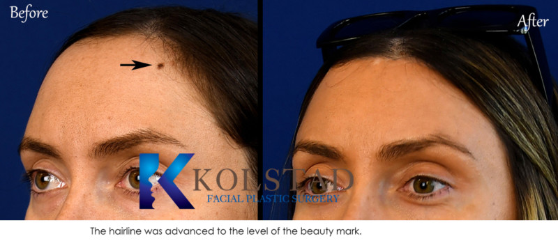 Hairline Advancement Surgery | Kolstad Hair Restoration