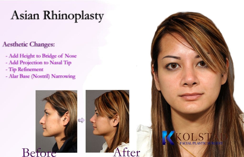 Asian Rhinoplasty | Dr. Kolstad - San Diego Facial Plastic Surgeon