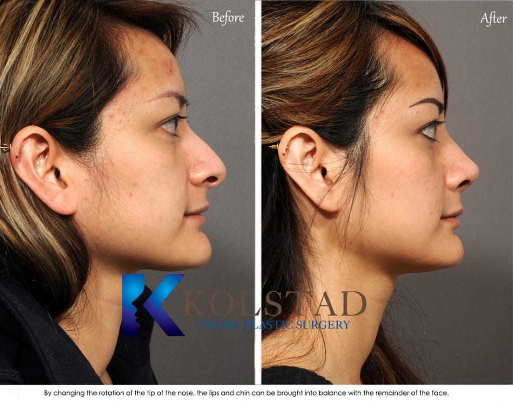 Asian Rhinoplasty Before And After Gallery Dr Kolstad San Diego