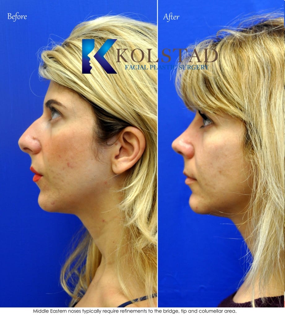 Hanging Columella Plastic Surgery | Dr. Kolstad - San Diego Facial ...