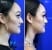 Rhinoplasty in San Diego CA | Dr. Kolstad - San Diego Facial Plastic ...