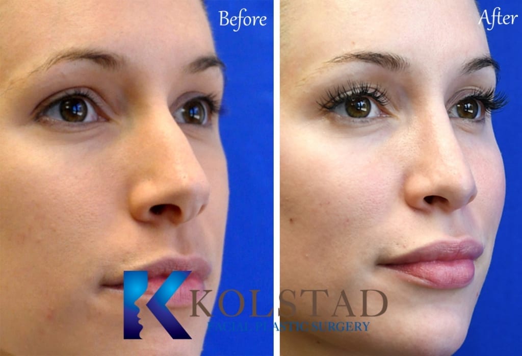 Wide Bridge Nose Job Before & After Gallery 1 | Dr. Kolstad - San Diego ...