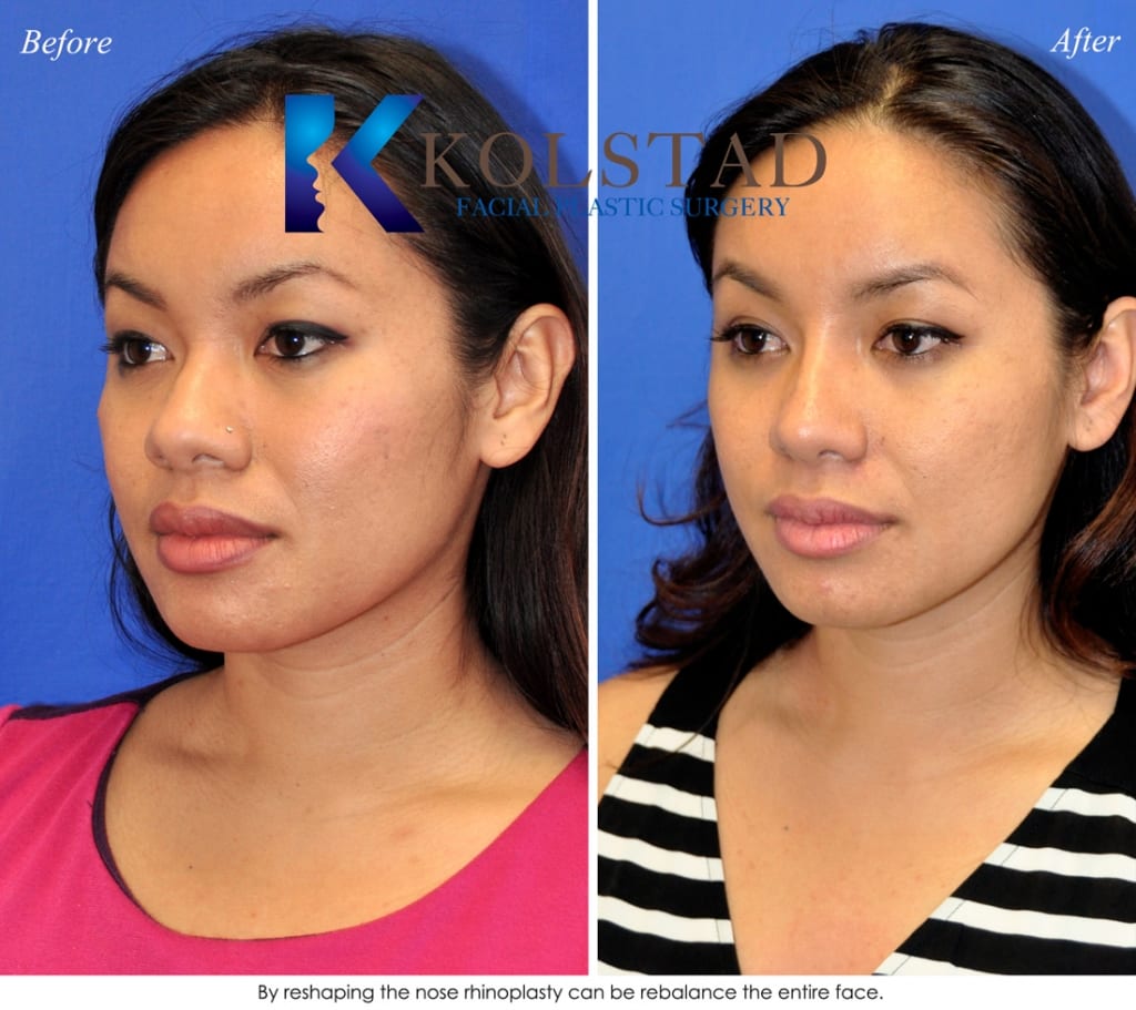 Asian Rhinoplasty Before & After Gallery | Dr. Kolstad - San Diego ...