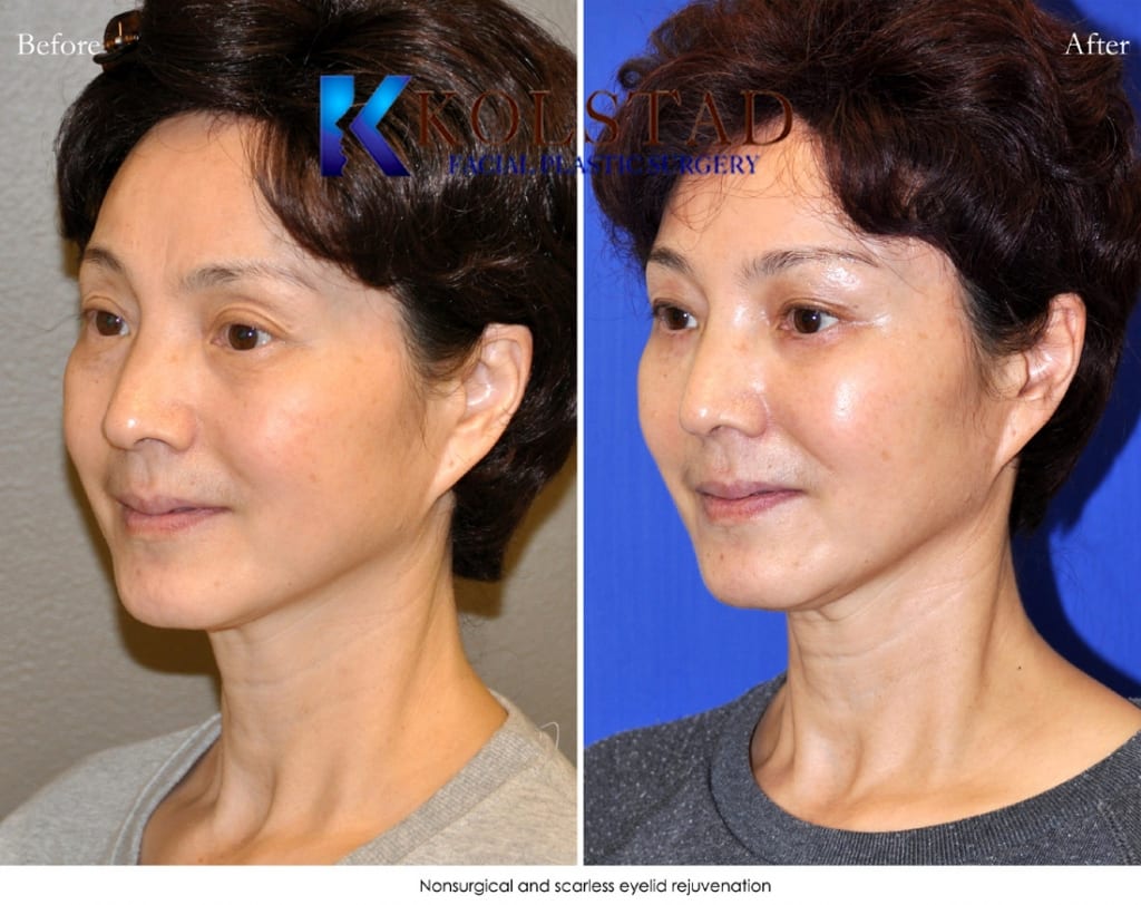 Asian Facelift Before & After Gallery | Dr. Kolstad - San Diego Facial ...