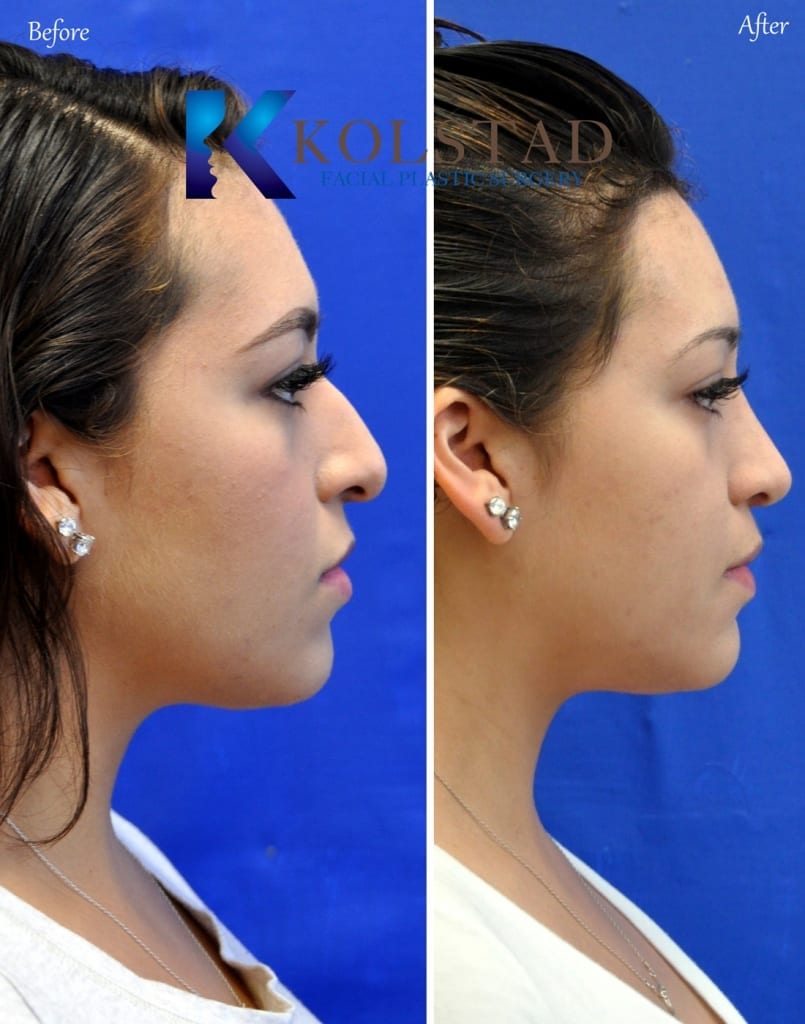 San Diego Nose Job for Droopy Nasal Tip 4 | Dr. Kolstad - San Diego ...