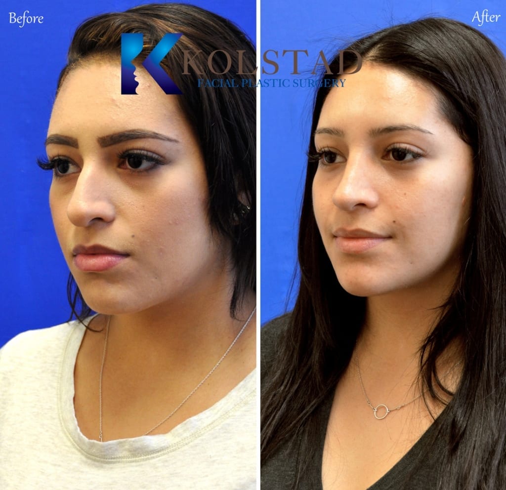 San Diego Nose Job for Droopy Nasal Tip 4 | Dr. Kolstad - San Diego ...