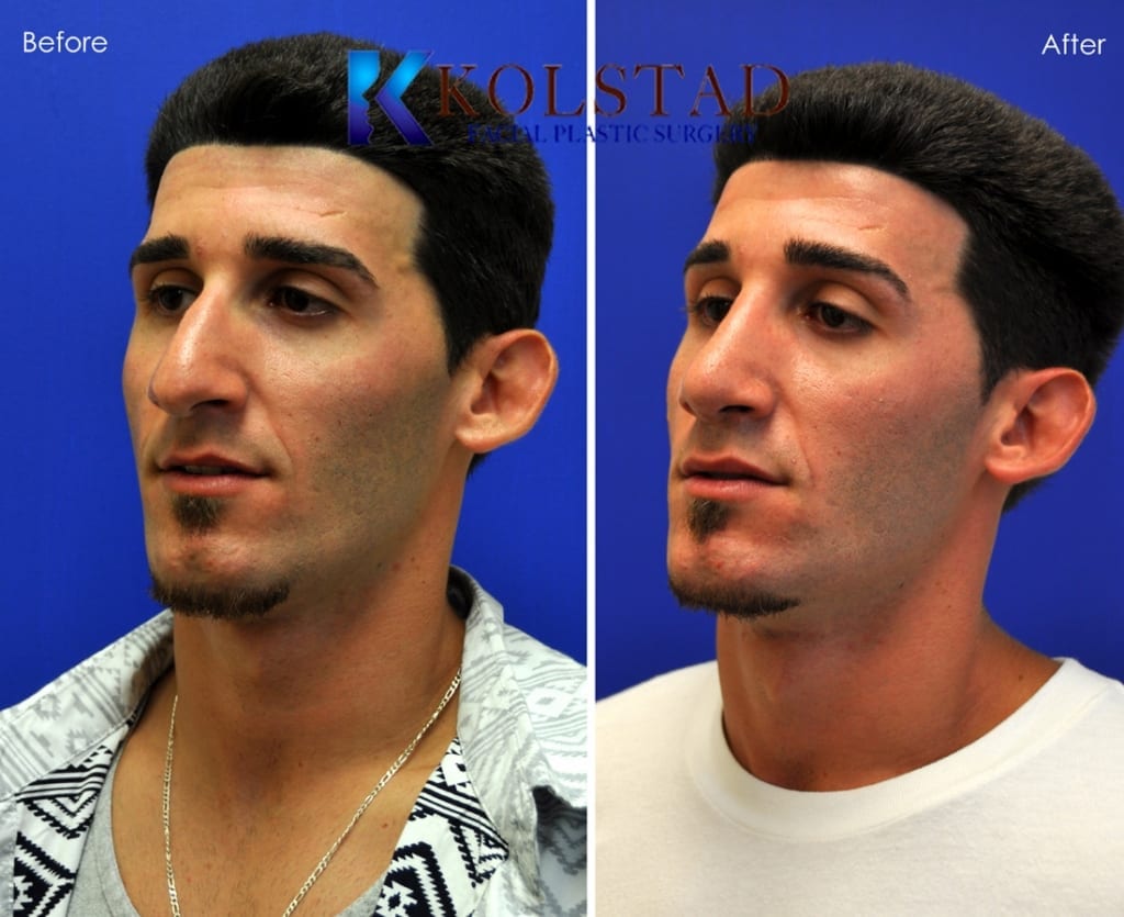 Nasal Tip Ptosis Nose Job for Men Before & After Gallery 19 | Dr ...