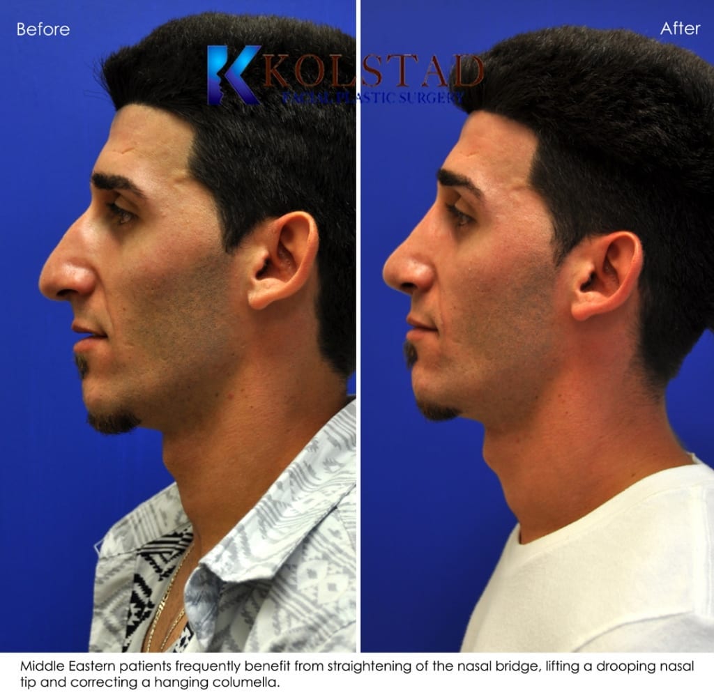 Nasal Tip Ptosis Nose Job for Men Before & After Gallery 19 | Dr ...