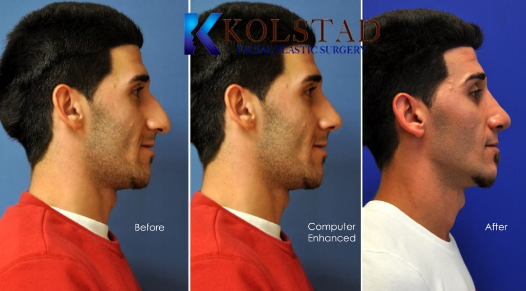 Nasal Tip Ptosis Nose Job for Men Before & After Gallery 19 | Dr ...