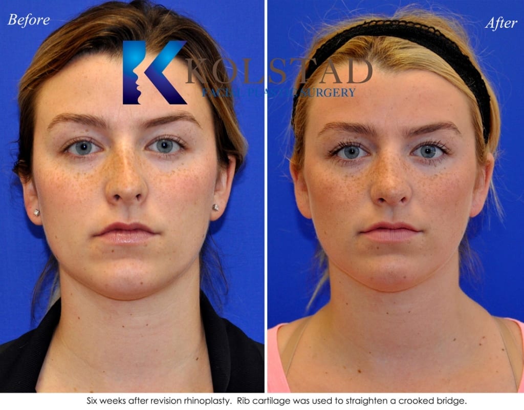 Deviated Bridge Revision Rhinoplasty San Diego 12 | Dr. Kolstad - San ...