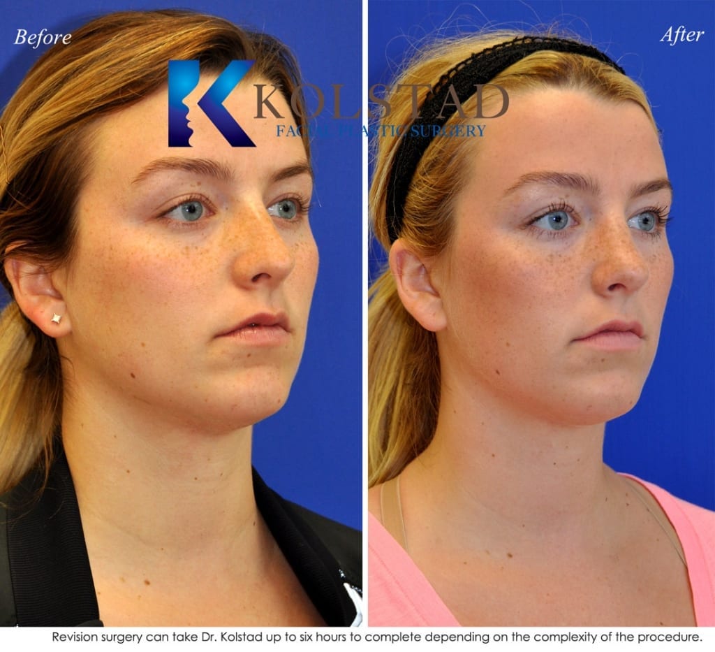 Deviated Bridge Revision Rhinoplasty San Diego 12 | Dr. Kolstad - San ...