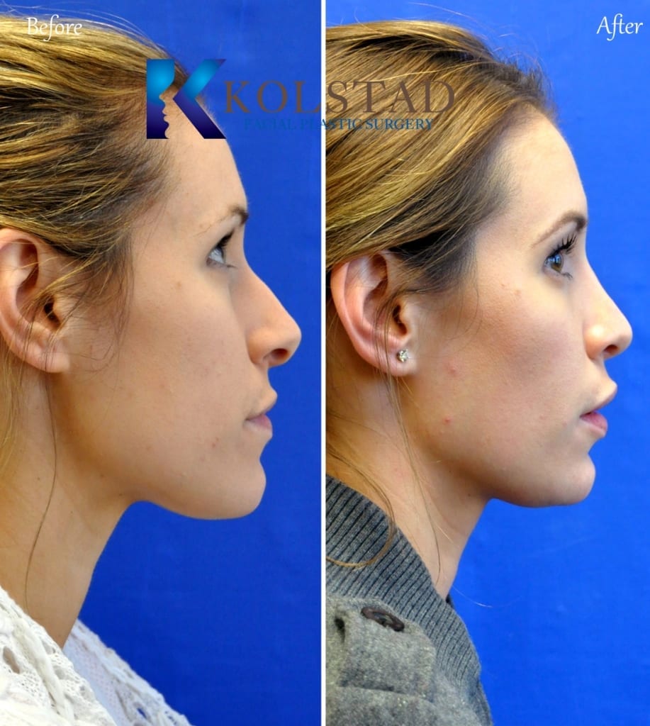 Wide Bridge Nose Job Before & After Gallery 1 | Dr. Kolstad - San Diego ...