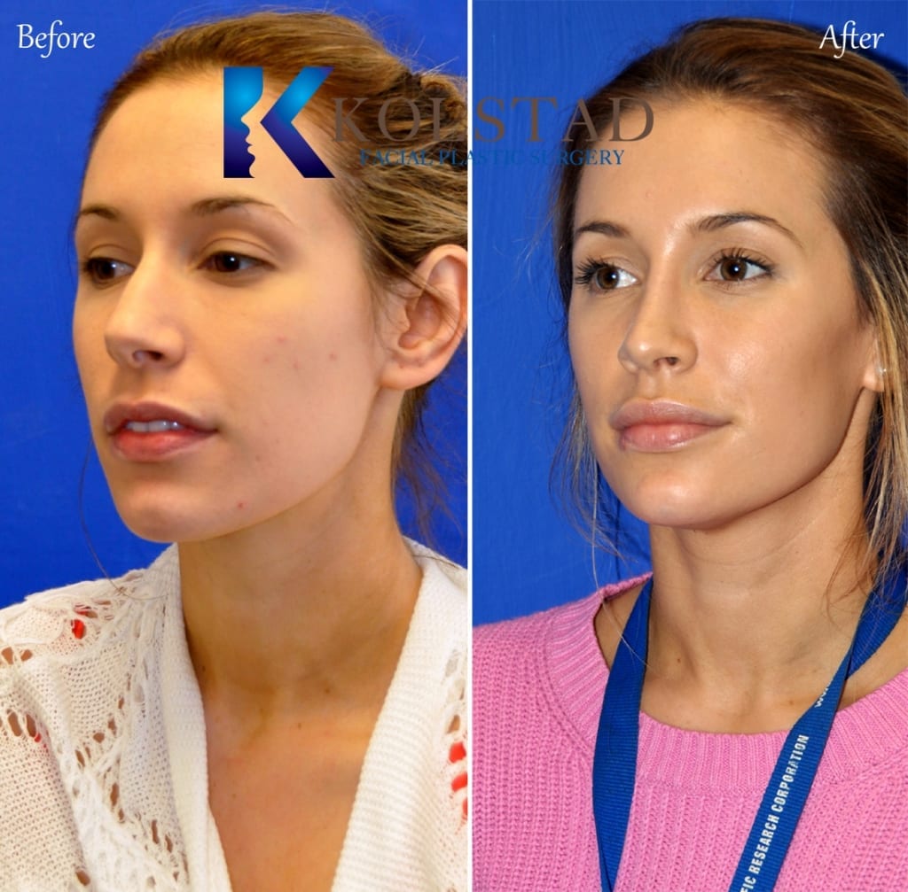 Wide Bridge Nose Job Before & After Gallery 1 | Dr. Kolstad - San Diego ...