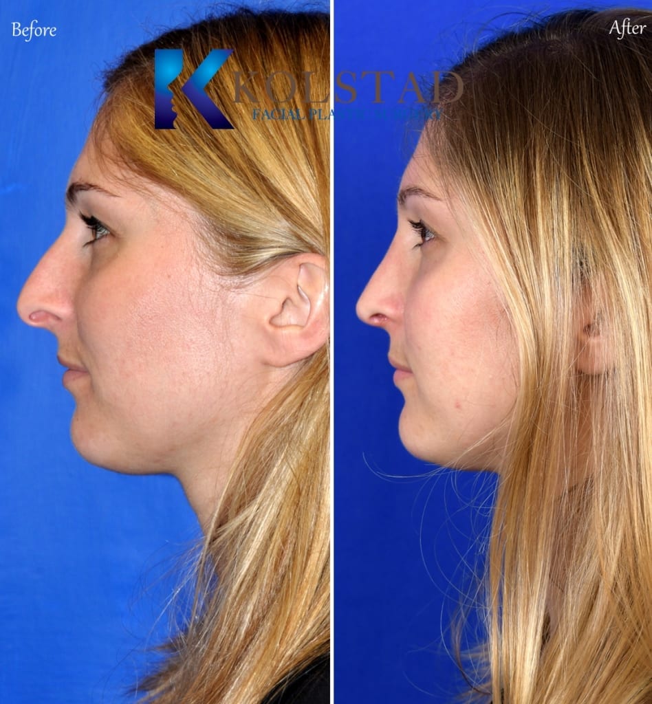 Rhinoplasty for Wide Noses San Diego 4 | Dr. Kolstad - San Diego Facial ...