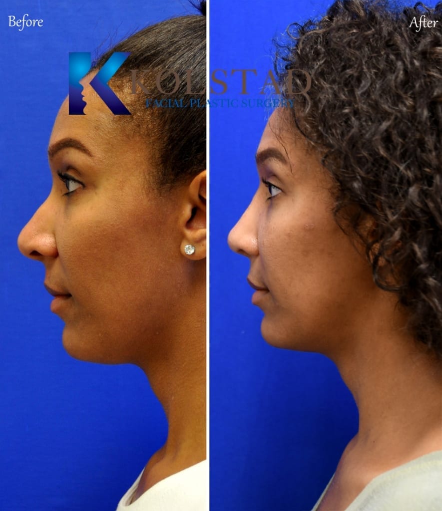 San Diego Rhinoplasty to Lift a Droopy Nasal Tip 9 | Dr. Kolstad - San ...