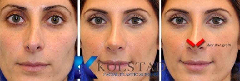 Rhinoplasty in San Diego CA | Dr. Kolstad - San Diego Facial Plastic ...