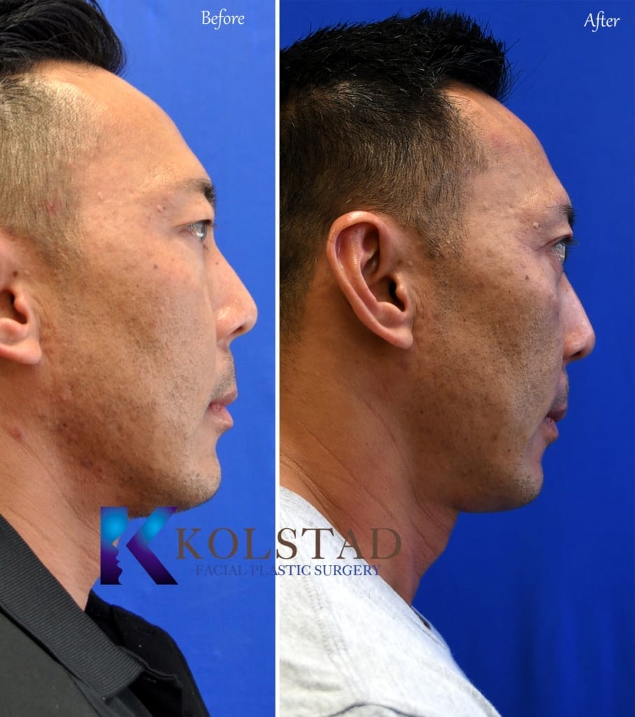 Asian Eyelid Surgery Before & After Gallery | Dr. Kolstad - San Diego ...
