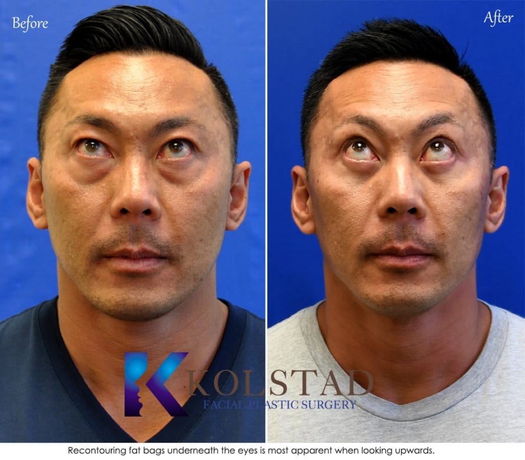 Asian Eyelid Surgery Before & After Gallery | Dr. Kolstad - San Diego ...