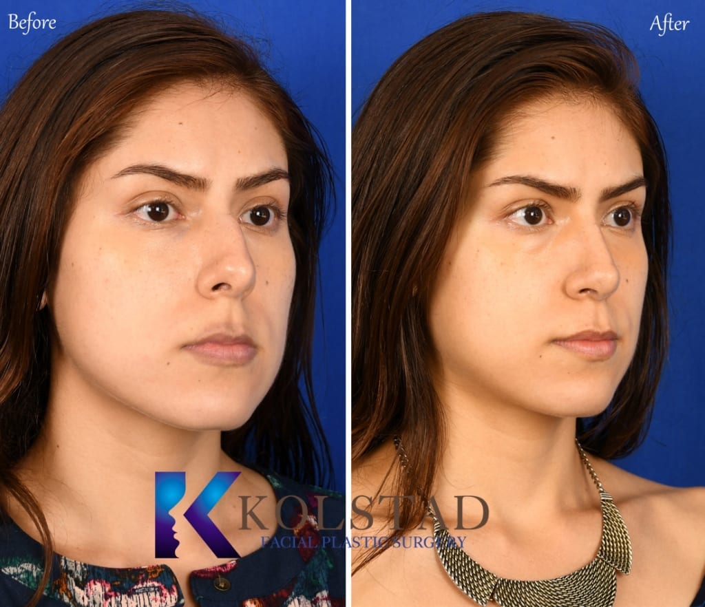 Hispanic Rhinoplasty Before & After Gallery 21 | Dr. Kolstad - San ...