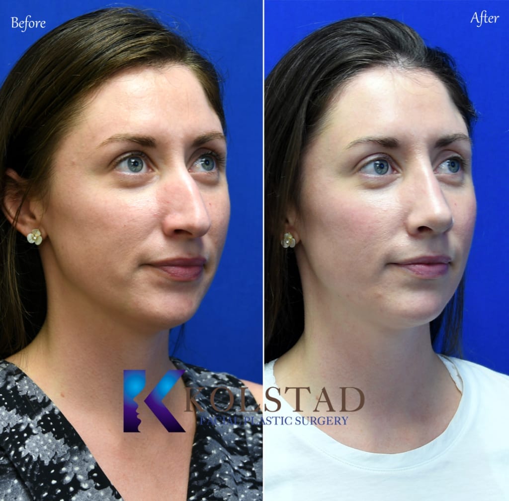 Columella Reduction Rhinoplasty | Dr. Kolstad - San Diego Facial ...