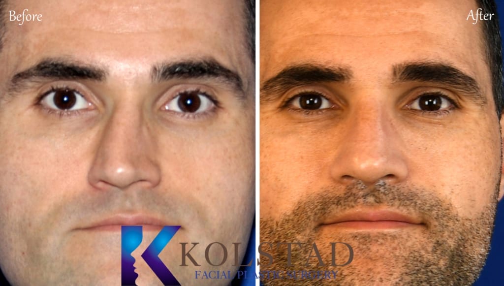 Male Rhinoplasty San Diego | Dr. Kolstad - San Diego Facial Plastic Surgeon