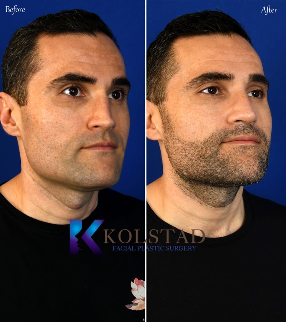 Male Rhinoplasty San Diego | Dr. Kolstad - San Diego Facial Plastic Surgeon
