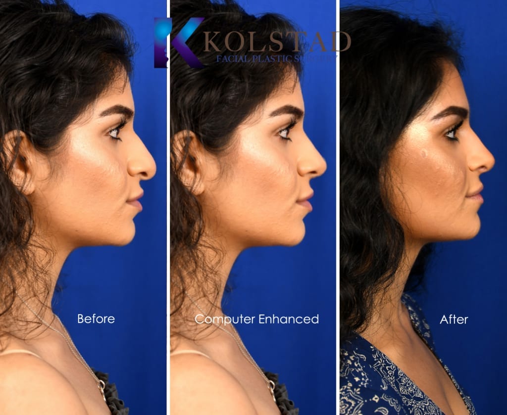 Drooping Tip Rhinoplasty San Diego Before & After Gallery 1 | Dr ...