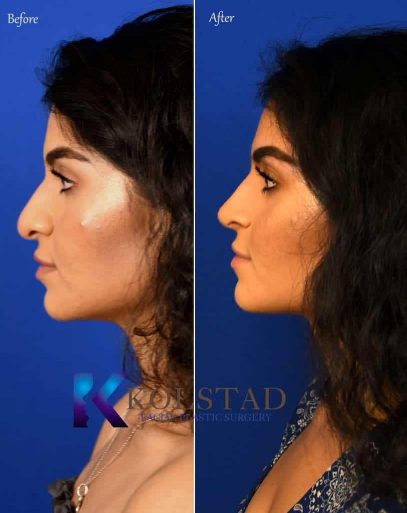 Drooping Tip Rhinoplasty San Diego Before & After Gallery 1 | Dr ...