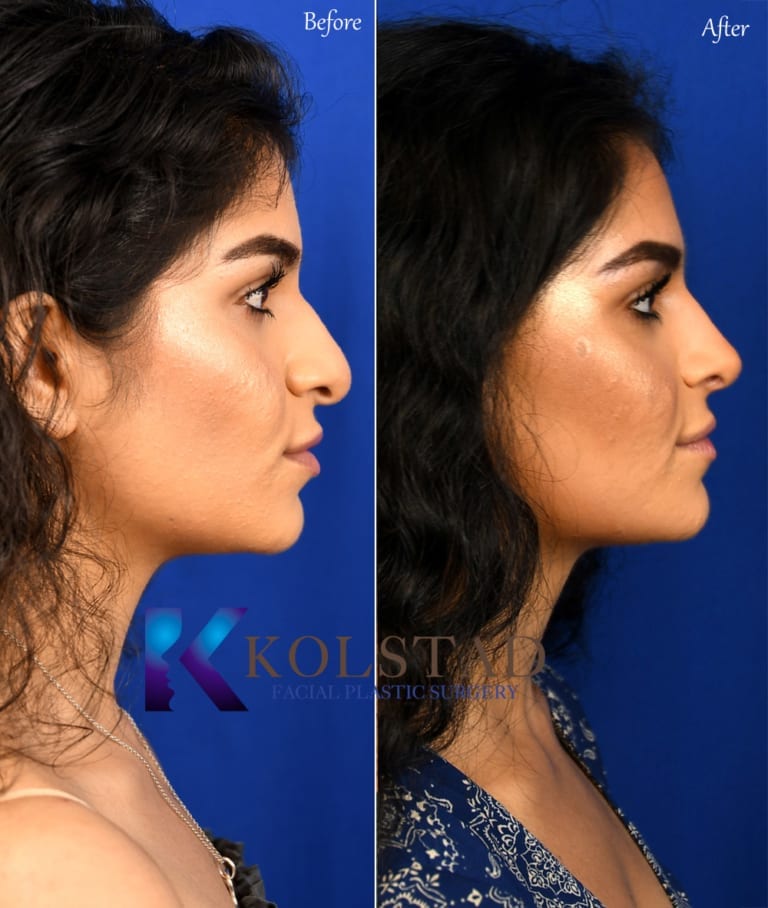 Drooping Tip Rhinoplasty San Diego Before & After Gallery 1 | Dr ...