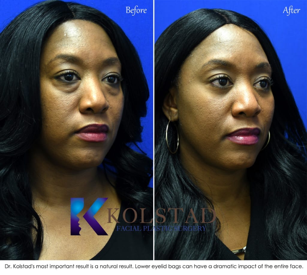 Eyelid Lift Surgery Before & After Gallery 6 | Dr. Kolstad - San Diego ...
