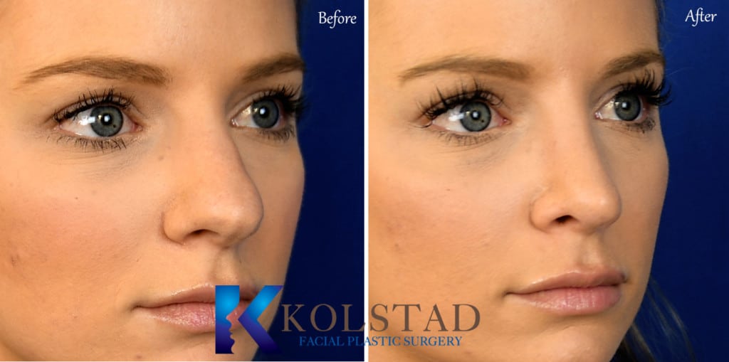 Surgery for Wide Noses Before & After Gallery 8 | Dr. Kolstad - San ...