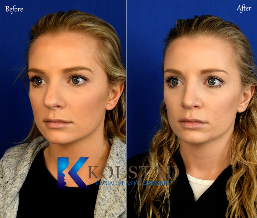 Surgery for Wide Noses Before & After Gallery 8 | Dr. Kolstad - San ...