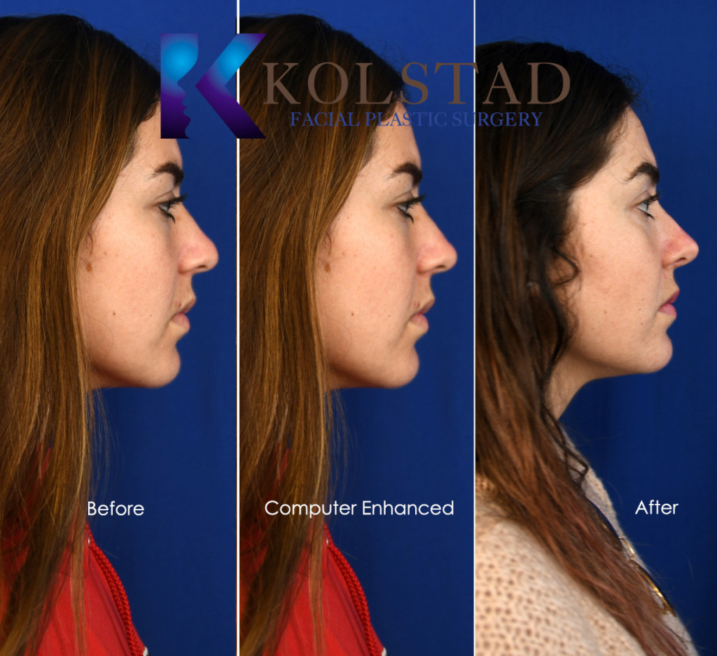 Nose Job to Reshape Bulbous Shape 3 | Dr. Kolstad - San Diego Facial ...