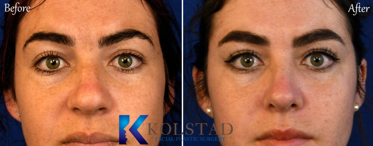 Nose Job to Reshape Bulbous Shape 3 | Dr. Kolstad - San Diego Facial ...