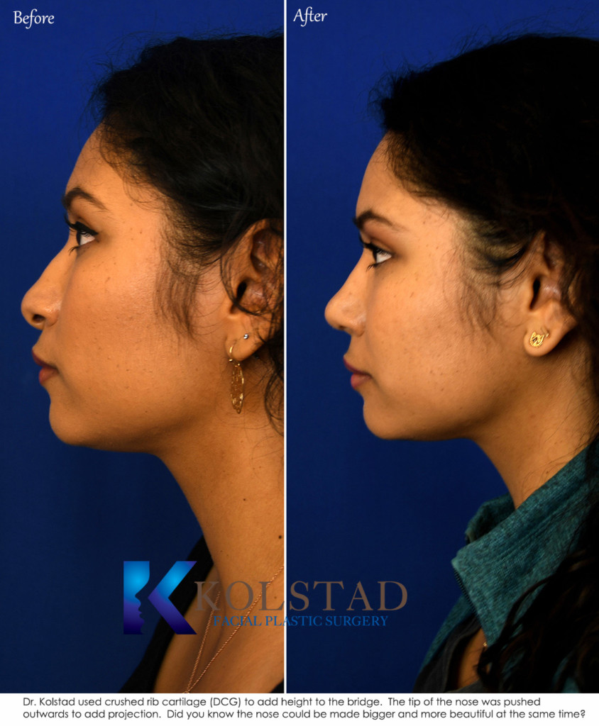 Hispanic Rhinoplasty Before & After Gallery 11 | Dr. Kolstad - San ...