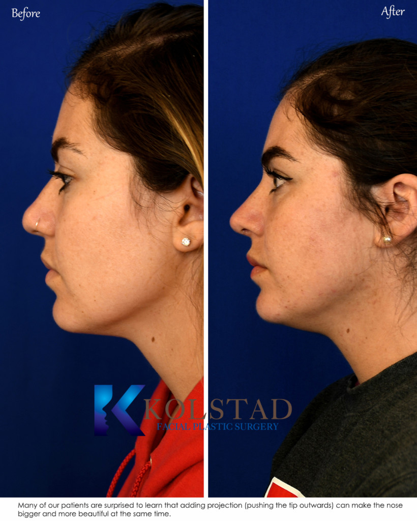 Nose Job to Reshape Bulbous Shape 3 | Dr. Kolstad - San Diego Facial ...