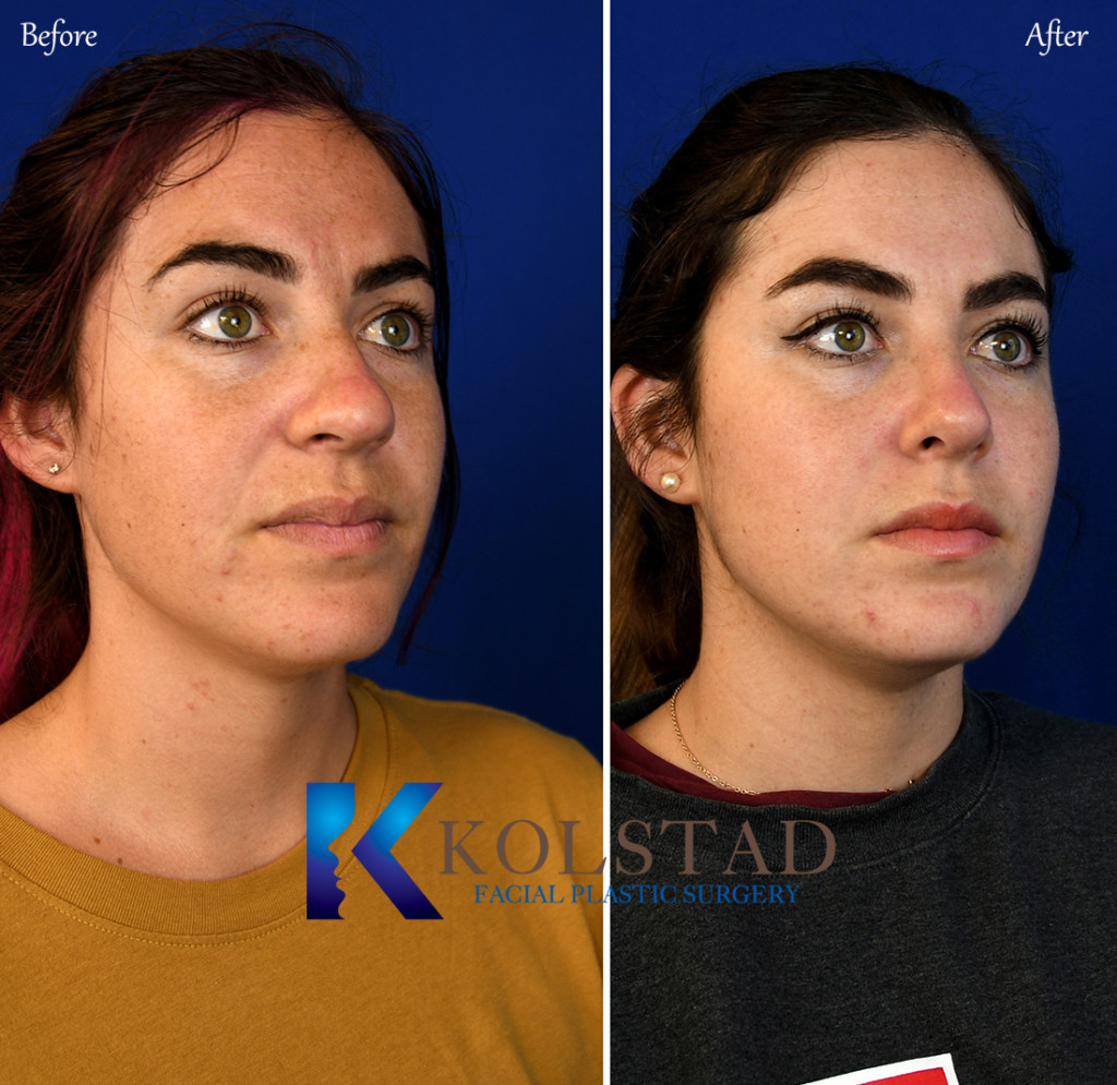 Nose Job to Reshape Bulbous Shape 3 | Dr. Kolstad - San Diego Facial ...