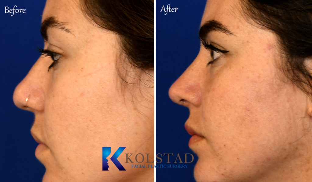 Nose Job to Reshape Bulbous Shape 3 | Dr. Kolstad - San Diego Facial ...