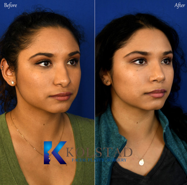 Hispanic Rhinoplasty Before & After Gallery 11 | Dr. Kolstad - San ...