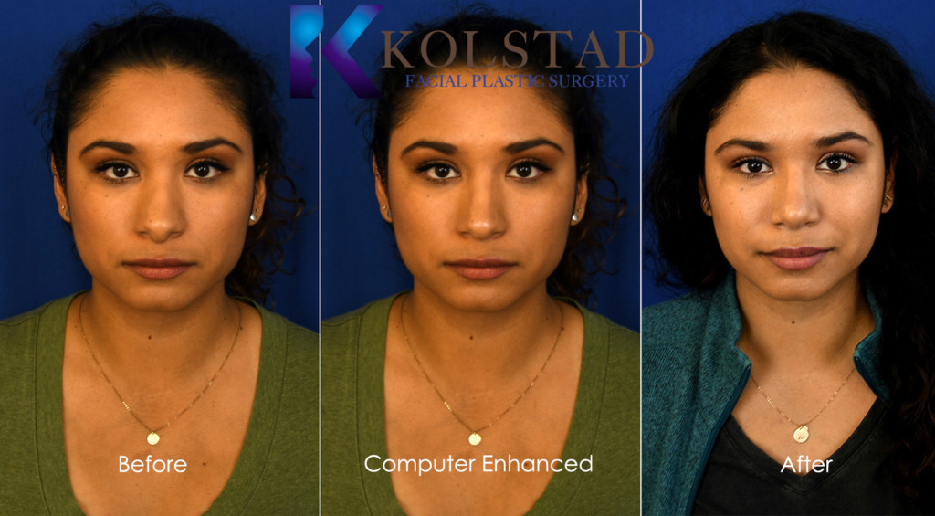 Hispanic Rhinoplasty Before & After Gallery 11 | Dr. Kolstad - San ...