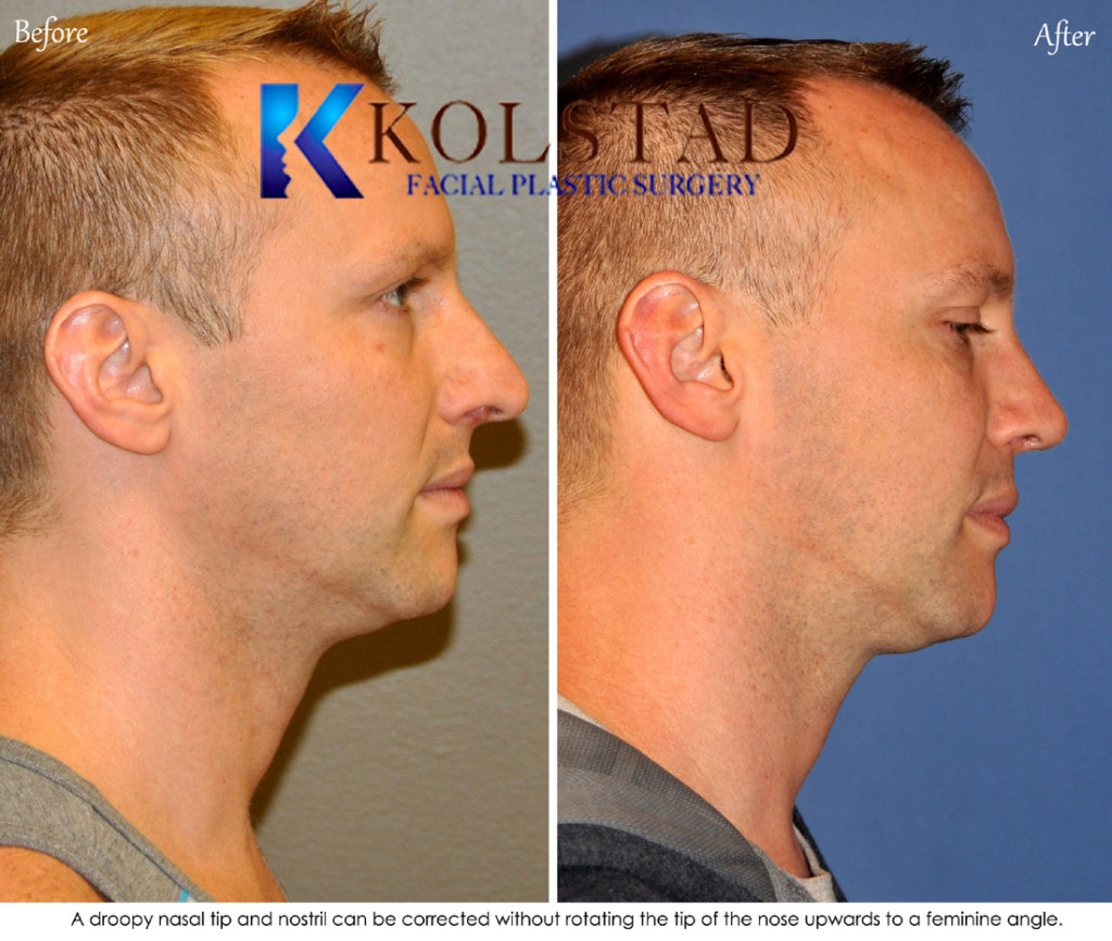 Droopy Nasal Tip and Nostril Correction | Dr. Kolstad - San Diego ...