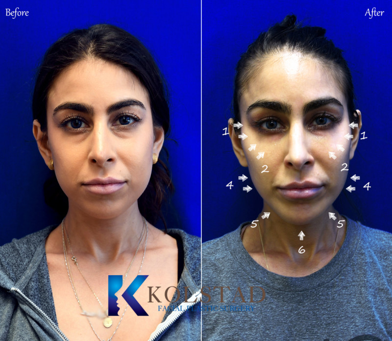 What Cheek Fillers Look Like | Dr. Kolstad - San Diego Facial Plastic ...
