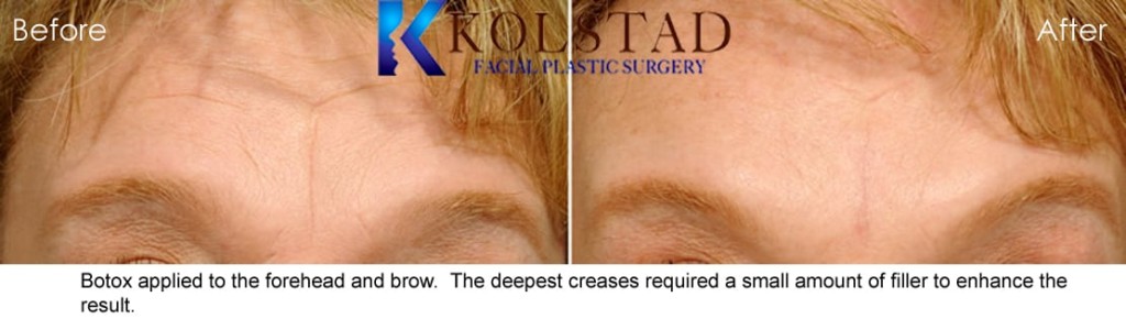 Natural Forehead Botox | Dr. Kolstad - San Diego Facial Plastic Surgeon