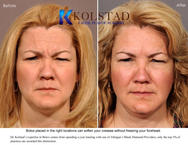 Botox Injections for Prominent Forehead Lines | Dr. Kolstad - San Diego ...
