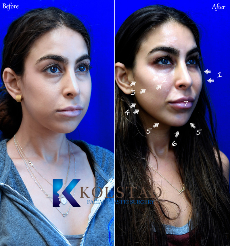 What Cheek Fillers Look Like | Dr. Kolstad - San Diego Facial Plastic ...