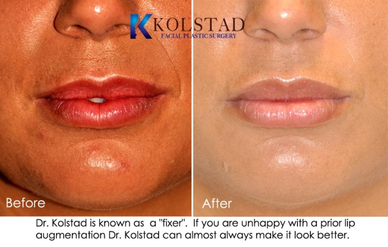 Revision Lip Filler Treatment with Juvederm | Dr. Kolstad - San Diego ...